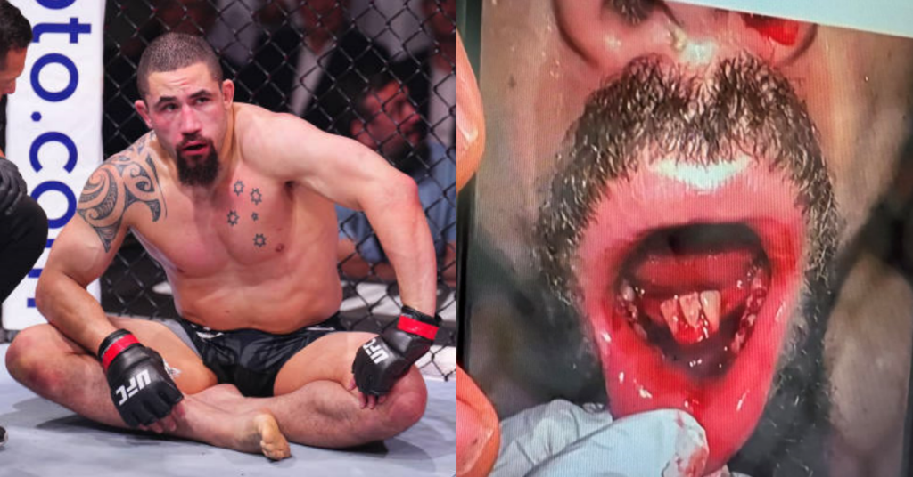 Robert Whittaker Suffers Broken Teeth, Dislocated Jaw In Submission ...