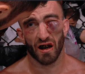 Look: BRUTAL Severe Swelling Of Mohammad Yahya Stuns UFC Fans