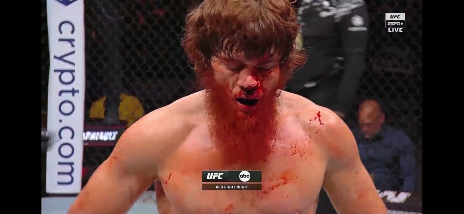 Shara Bullet Hospitalized In Abu Dhabi For Nose Surgery Following UFC Bout